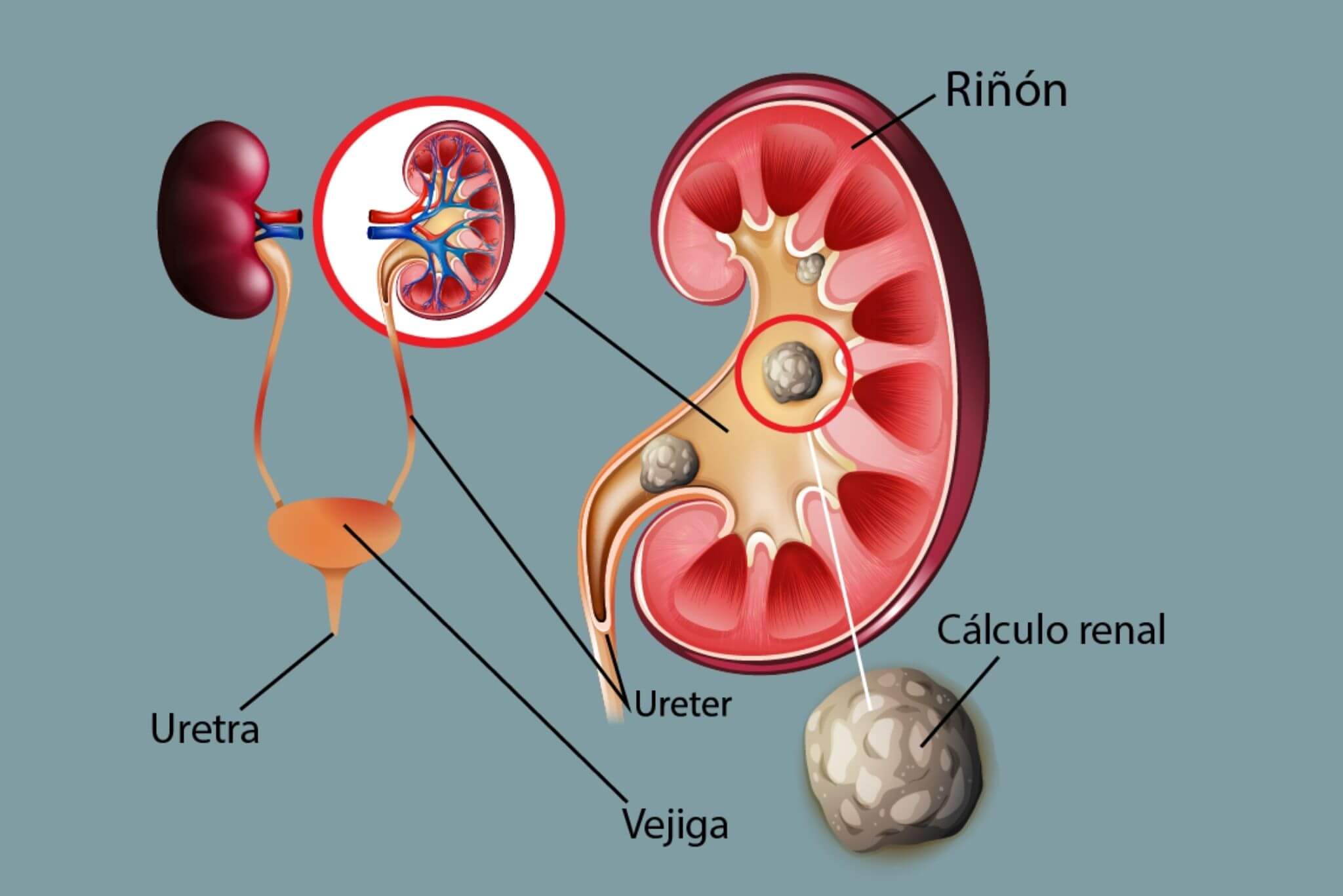 Piedras en el riñón y cólicos nefríticos. Por Dr. López - M&S Urología ...
